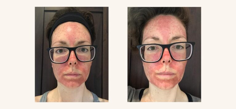 I Burned My Face for 4 Weeks to Try and Prevent Cancer - Hello Gloria